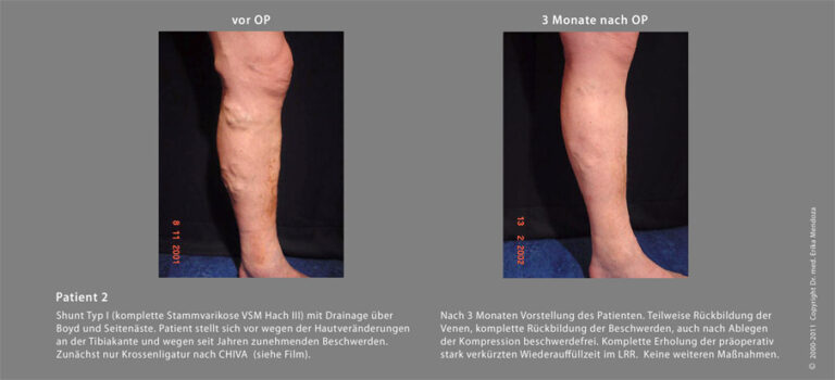 Für Mediziner – Die CHIVA-Methode